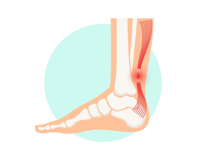 Medical infographic achilles tendon Royalty Free Vector