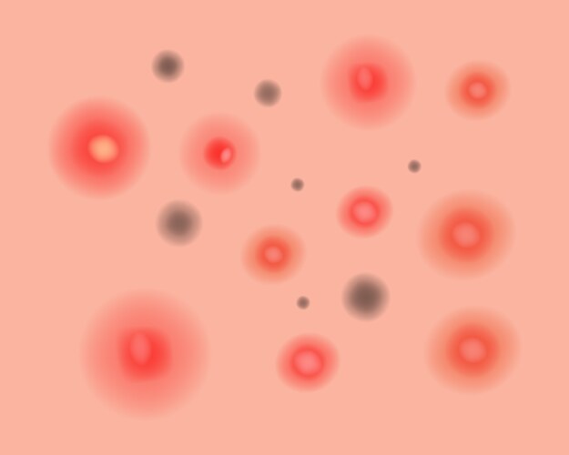 Grade Of Acne Severity Medical Diagram Different Vector Image