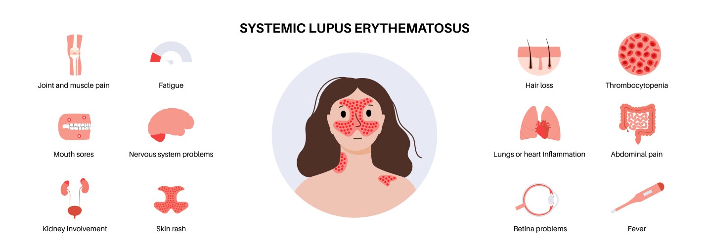 Systemic lupus erythematosus Royalty Free Vector Image