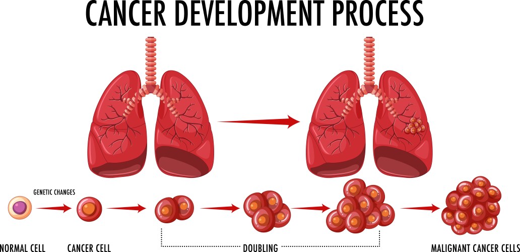 Cancer development process infographic Royalty Free Vector