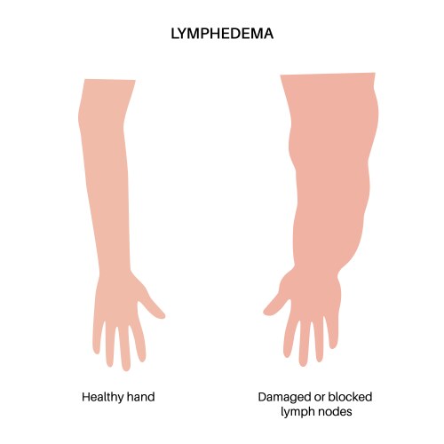 Lymphedema stages Royalty Free Vector Image - VectorStock