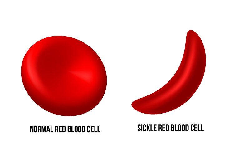 Sickle cell anemia Royalty Free Vector Image - VectorStock
