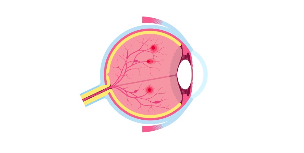 Diabetes related retinopathy Royalty Free Vector Image