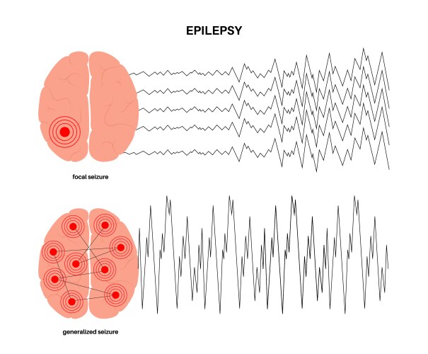 Epilepsy Vector Images (over 1,500)