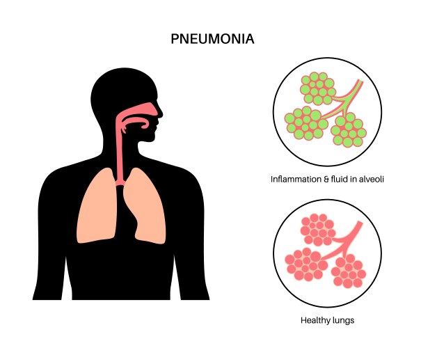 Pneumonia Vector Images (over 61,000)