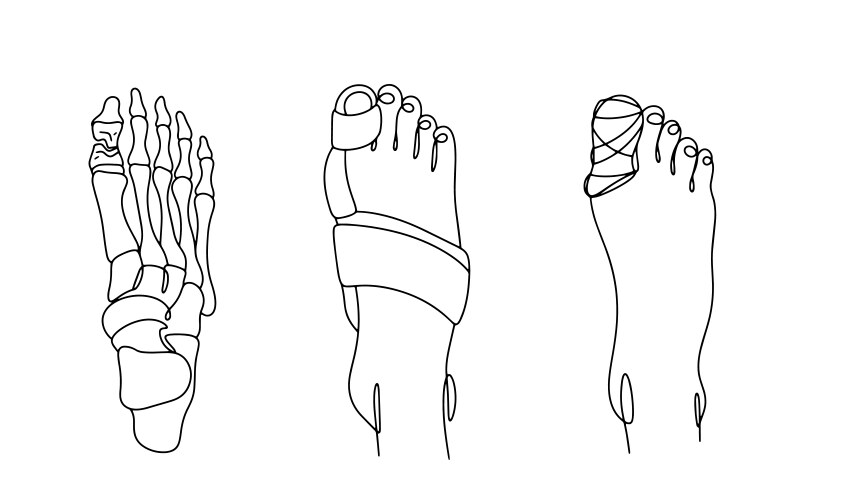 Types of spinal fracture Royalty Free Vector Image