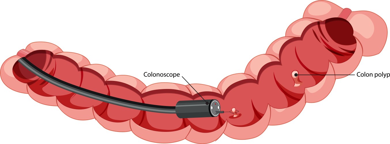Diagram showing polyp removal Royalty Free Vector Image