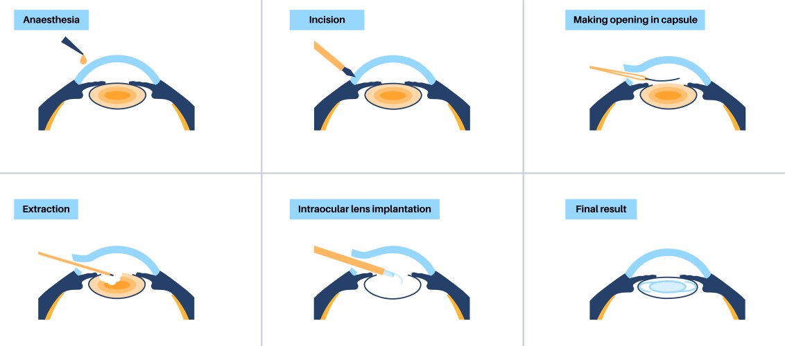 Cataract surgery poster Royalty Free Vector Image