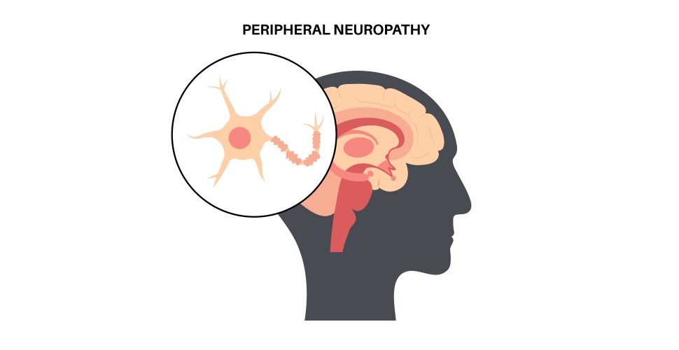 Peripheral neuropathy medical poster Royalty Free Vector