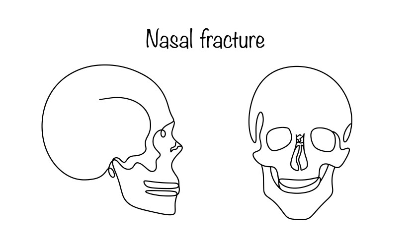 Nasal fracture nose Royalty Free Vector Image - VectorStock