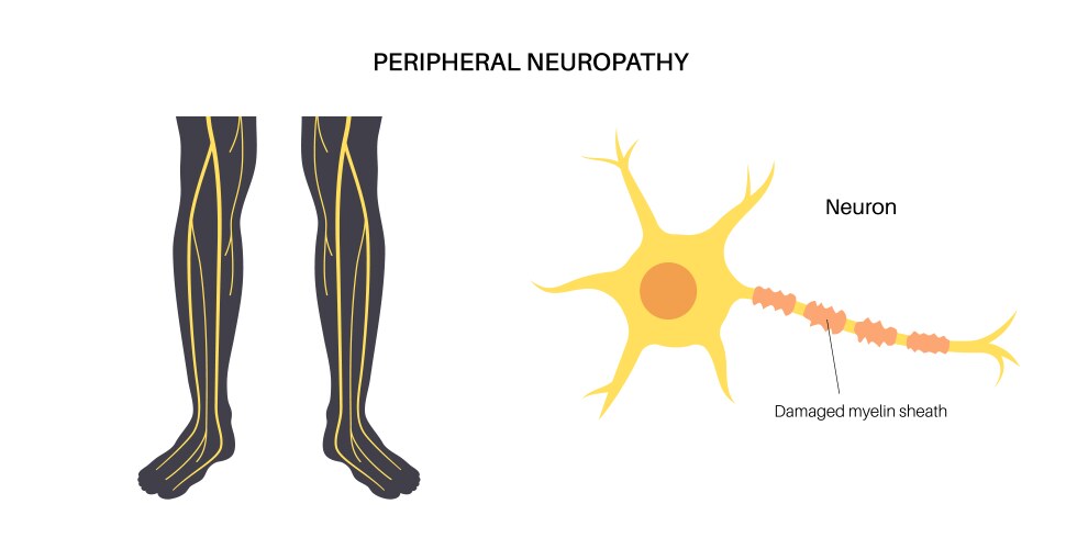 Peripheral neuropathy medical poster Royalty Free Vector