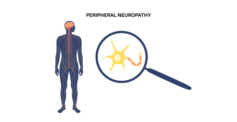Peripheral neuropathy medical poster Royalty Free Vector