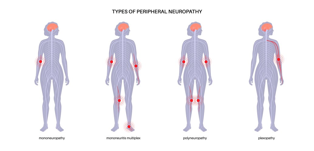 Peripheral neuropathy medical poster Royalty Free Vector