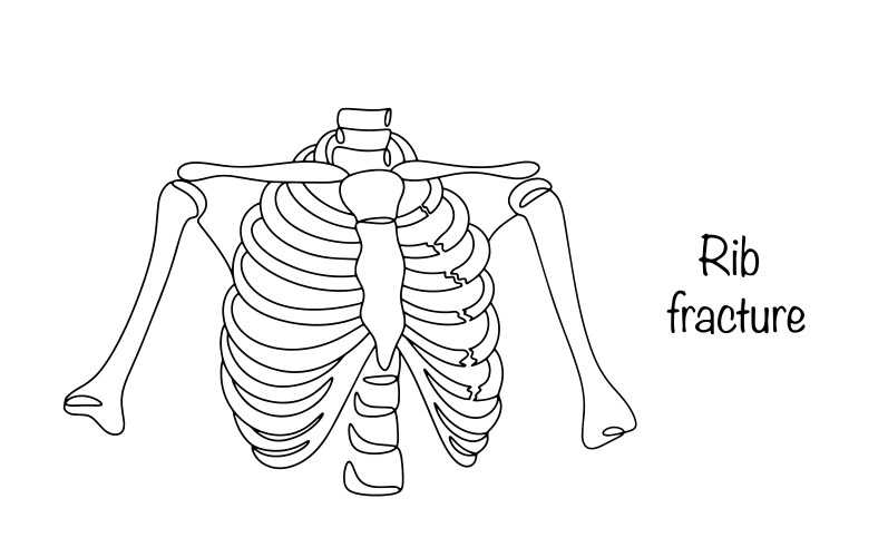 Fracture of forearm bones Royalty Free Vector Image