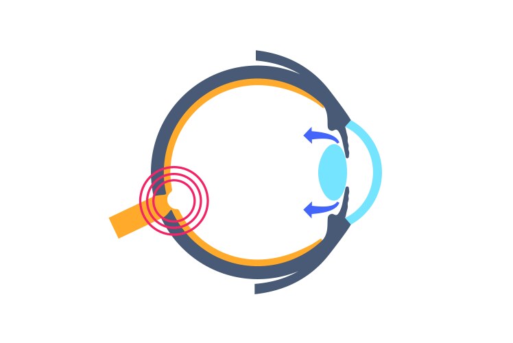 Glaucoma eye pressure Royalty Free Vector Image