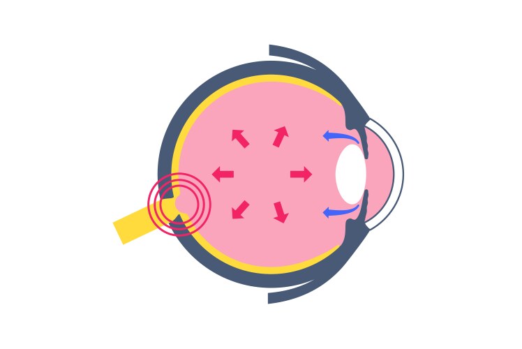 Glaucoma eye pressure Royalty Free Vector Image