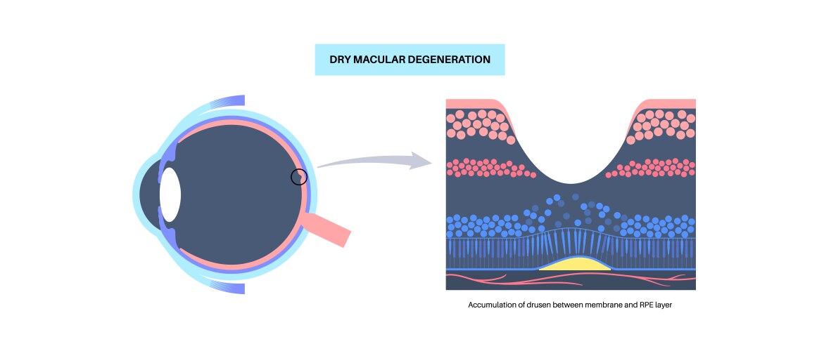 Macular Degeneration Vector Images (over 110)
