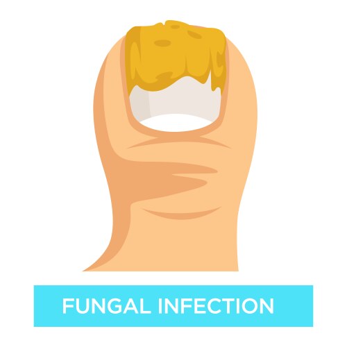 Fungal Nail Infection - Onychomycosis Royalty Free Vector