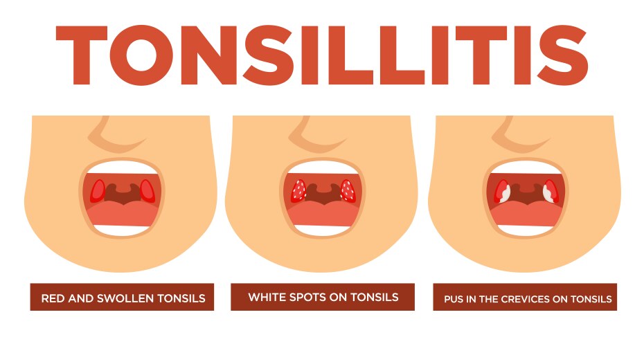 Tonsillitis Vector Images (over 1,200)