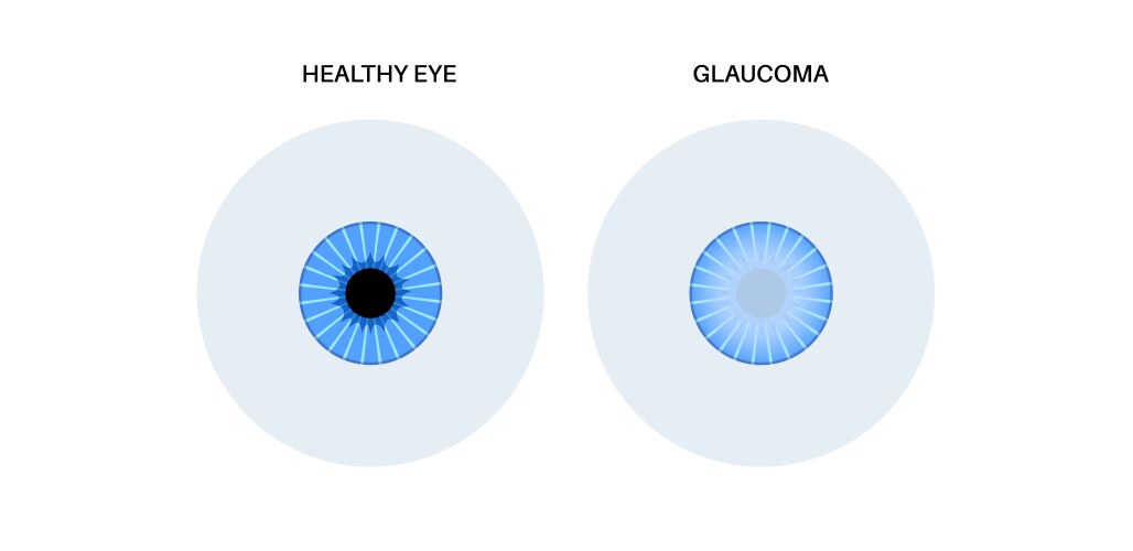 Glaucoma eye disease Royalty Free Vector Image