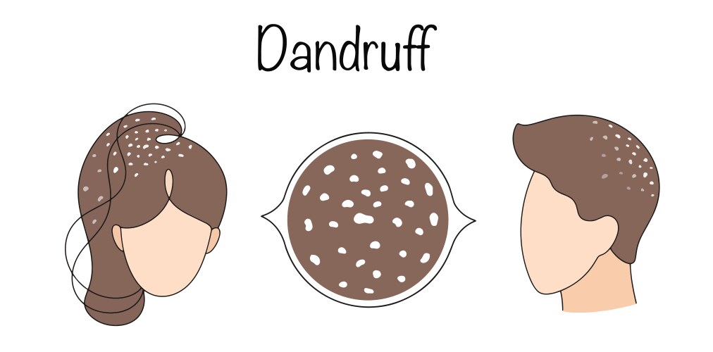 Dandruff Vector Images (over 3,200)
