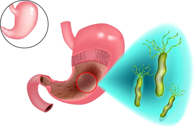 Helicobacter pylori medicine education diagram vec