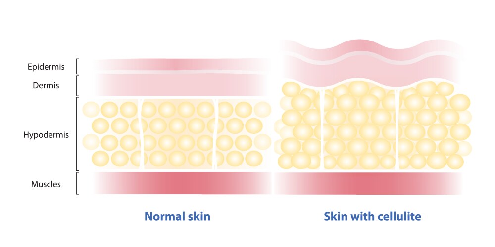 Subcutaneous Fat Vector Images (over 240)