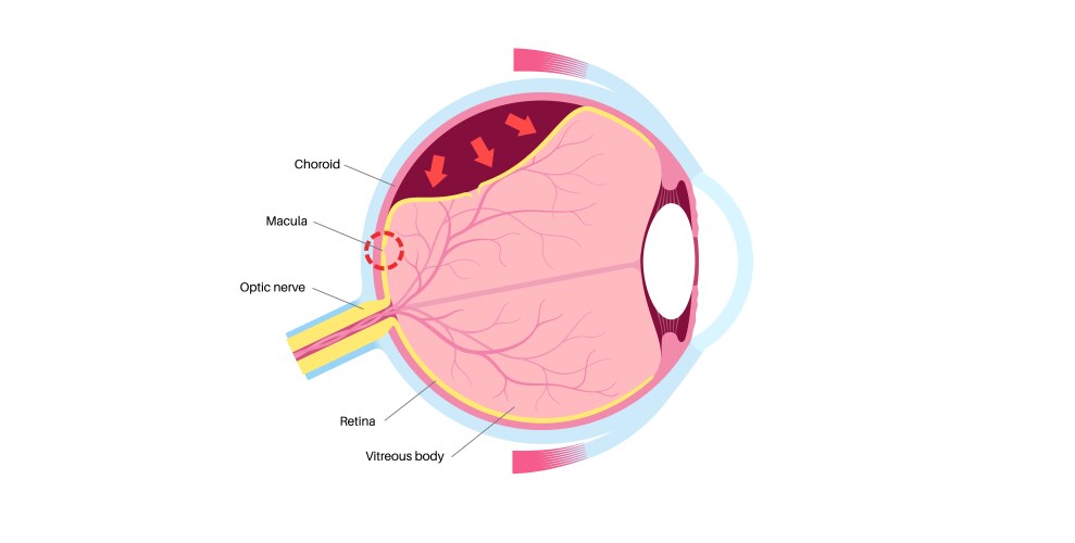 Macular Degeneration Vector Images (over 100)