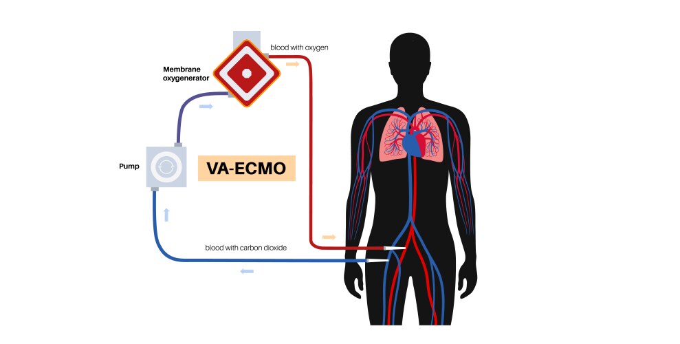Extracorporeal membrane oxygenation Royalty Free Vector
