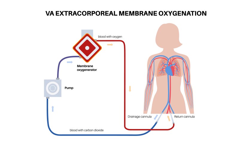 Extracorporeal membrane oxygenation Royalty Free Vector