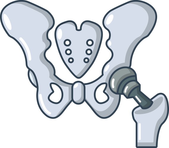 Total hip replacement surgery with anatomical Vector Image