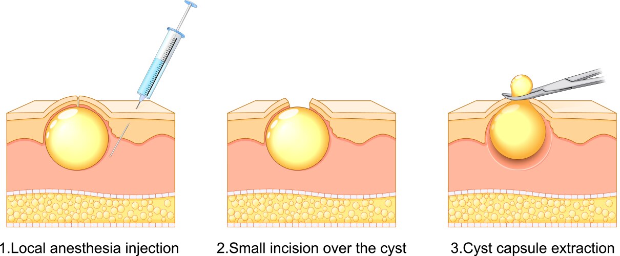 Skin Abscess Vector Images (over 160)