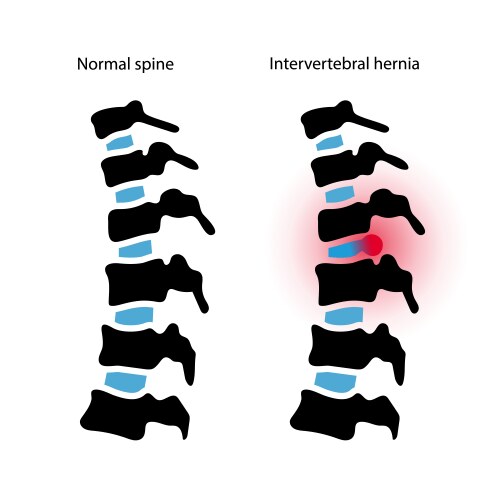 Hernia Vector Images (over 990)