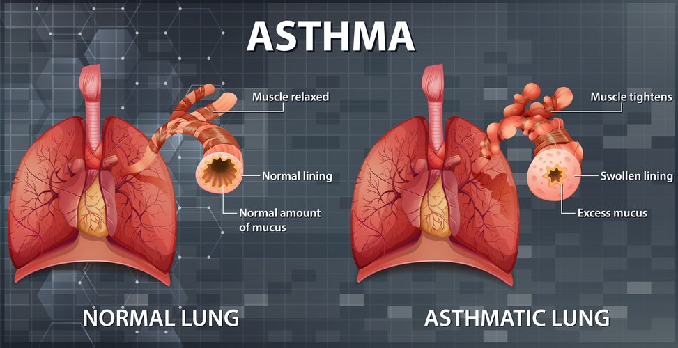 Asthma Lung Anatomy Comparison – Royalty-Free Vector | VectorStock