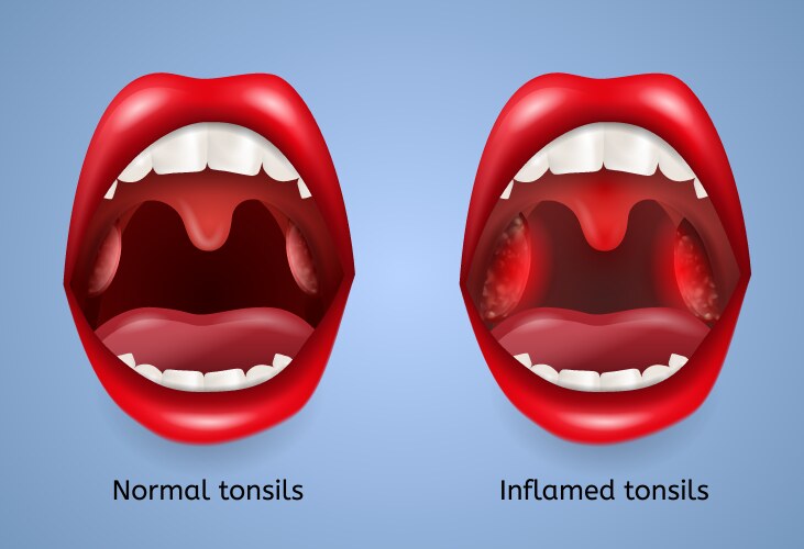 Candidiasis tongue thrush inflammation Royalty Free Vector