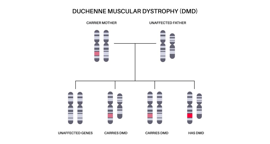 Duchenne muscular dystrophy Royalty Free Vector Image
