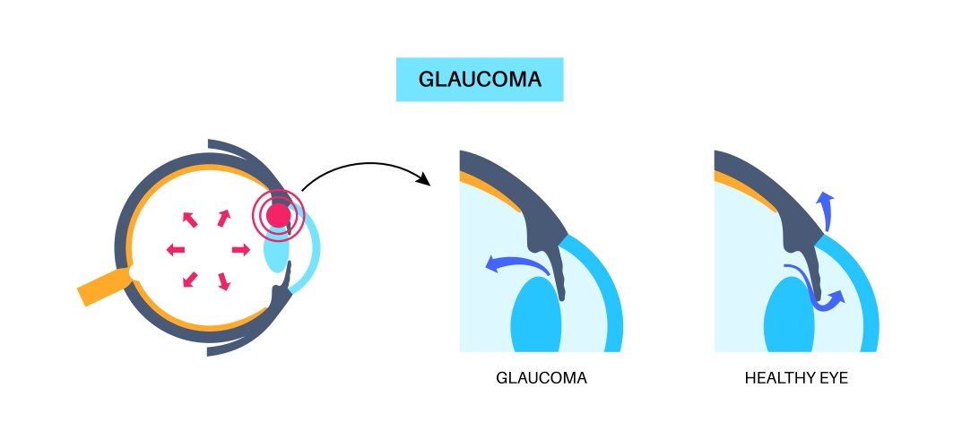 Glaucoma eye disease Royalty Free Vector Image