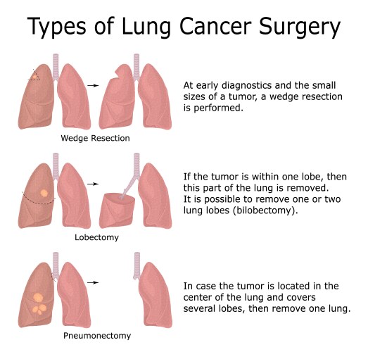 Lung cancer types Royalty Free Vector Image - VectorStock