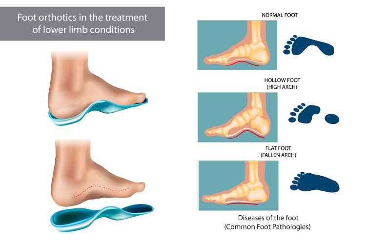 Diabetic foot Royalty Free Vector Image - VectorStock