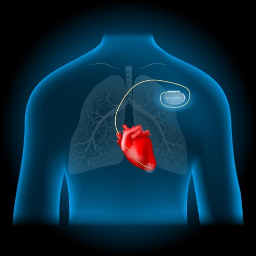 Pacemaker Vector Images (over 870)