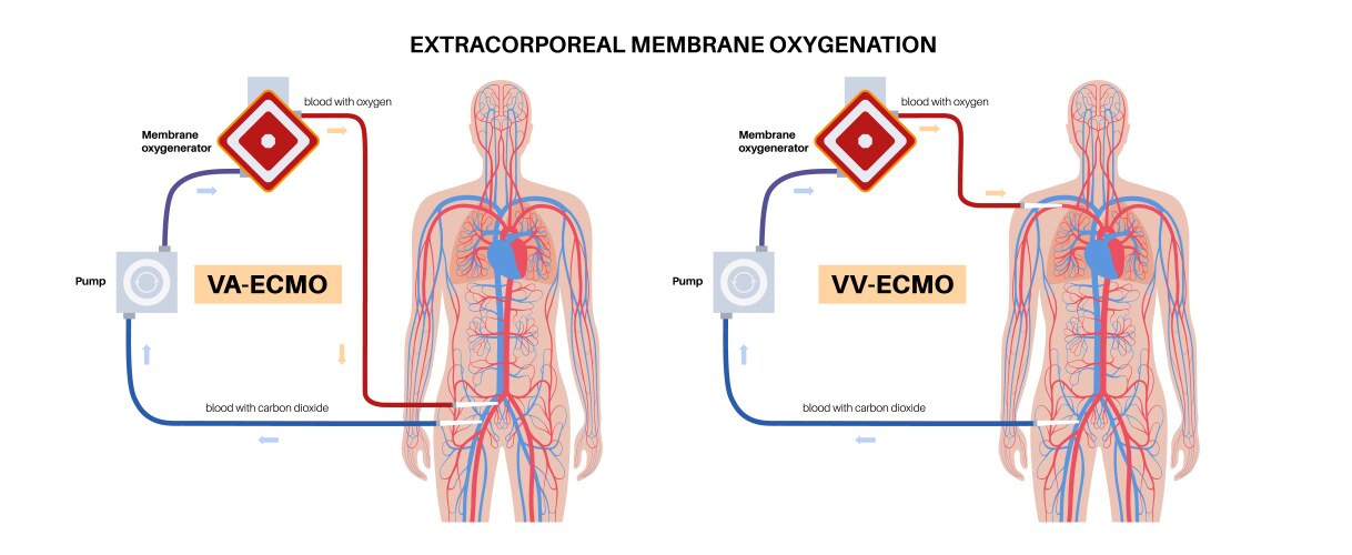Extracorporeal membrane oxygenation Royalty Free Vector
