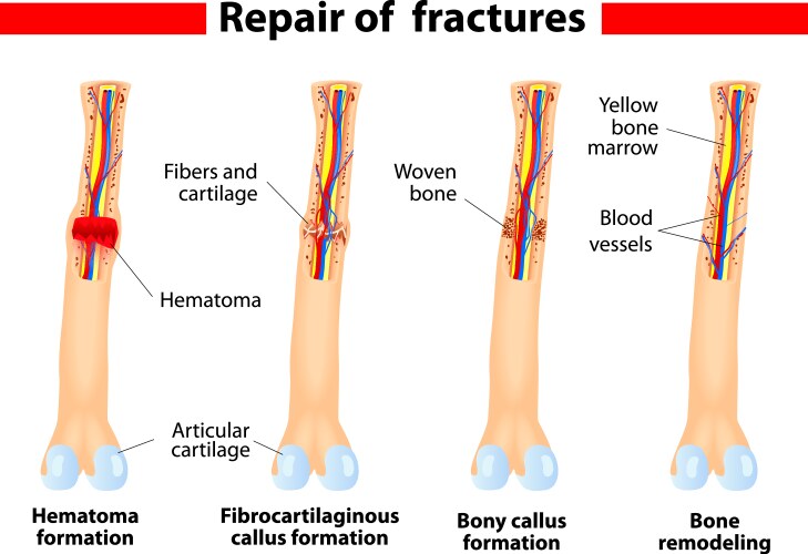 Bone Fracture Hematoma Vector Images (38)