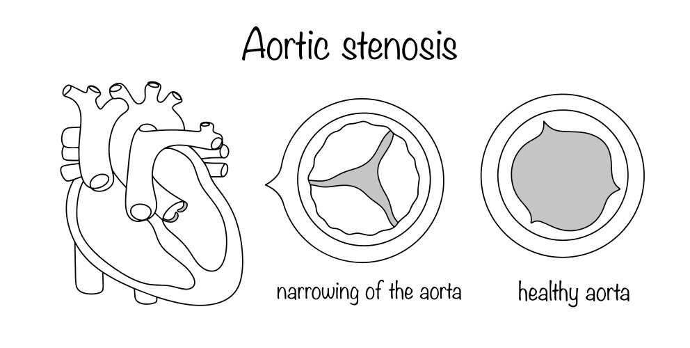 Aortic Valve Vector Images (over 120)