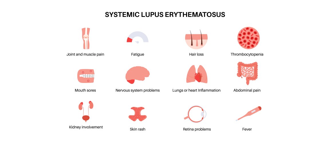 Systemic lupus erythematosus Royalty Free Vector Image