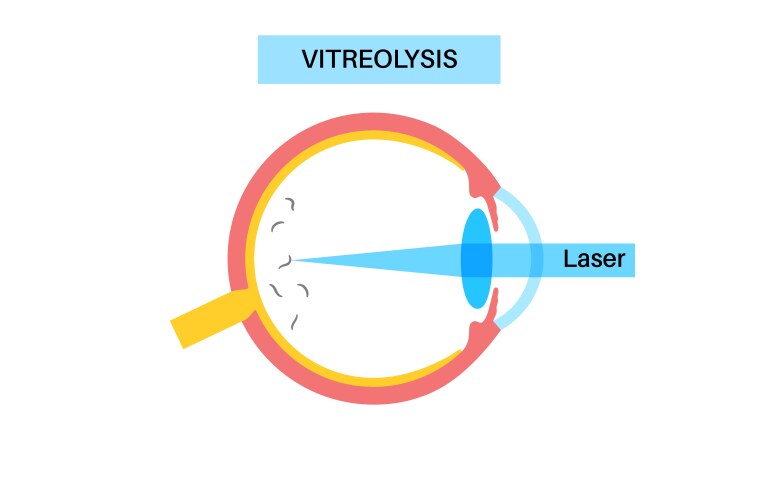 Laser Vector Images (over 140,000)