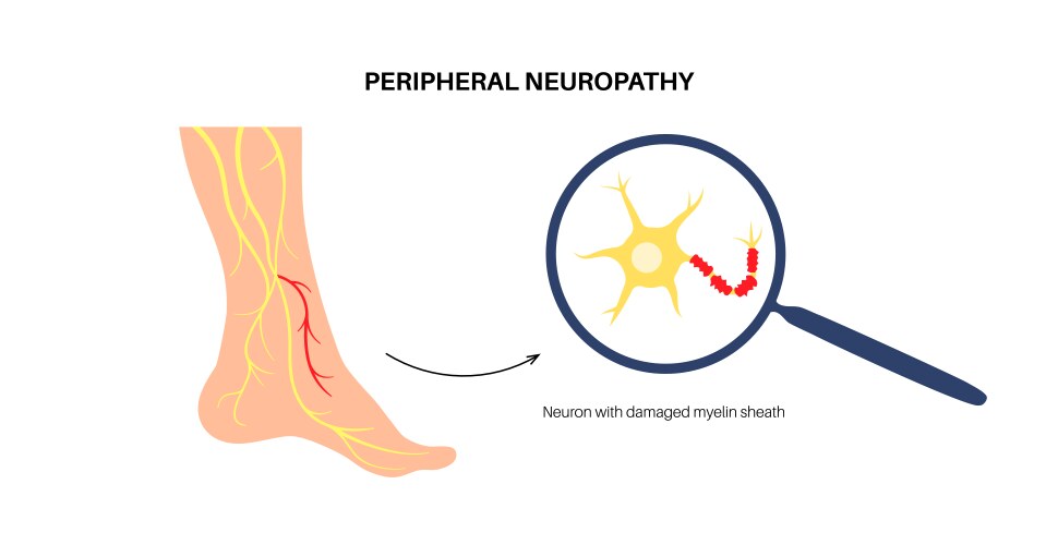 Peripheral neuropathy medical poster Royalty Free Vector