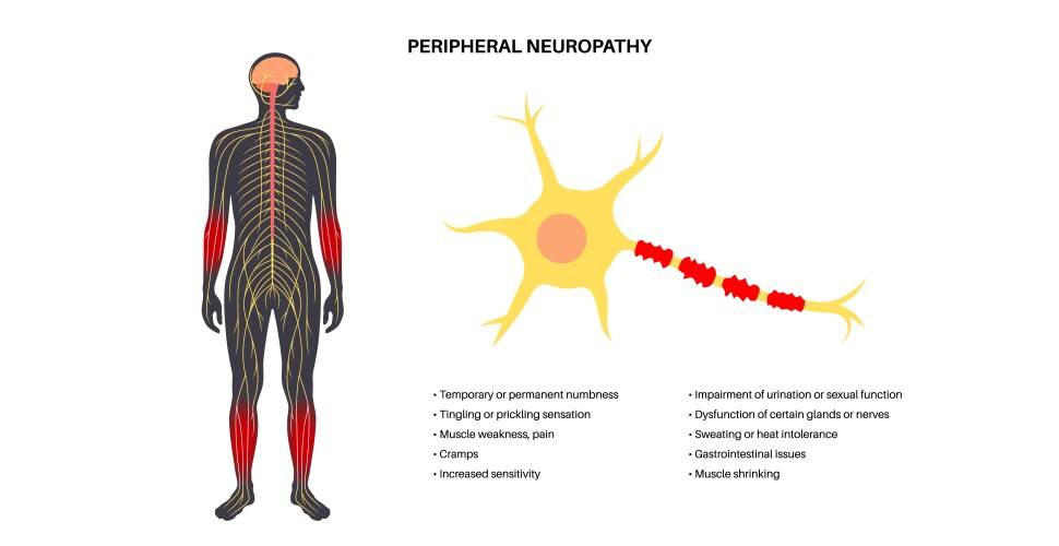 Peripheral neuropathy medical poster Royalty Free Vector