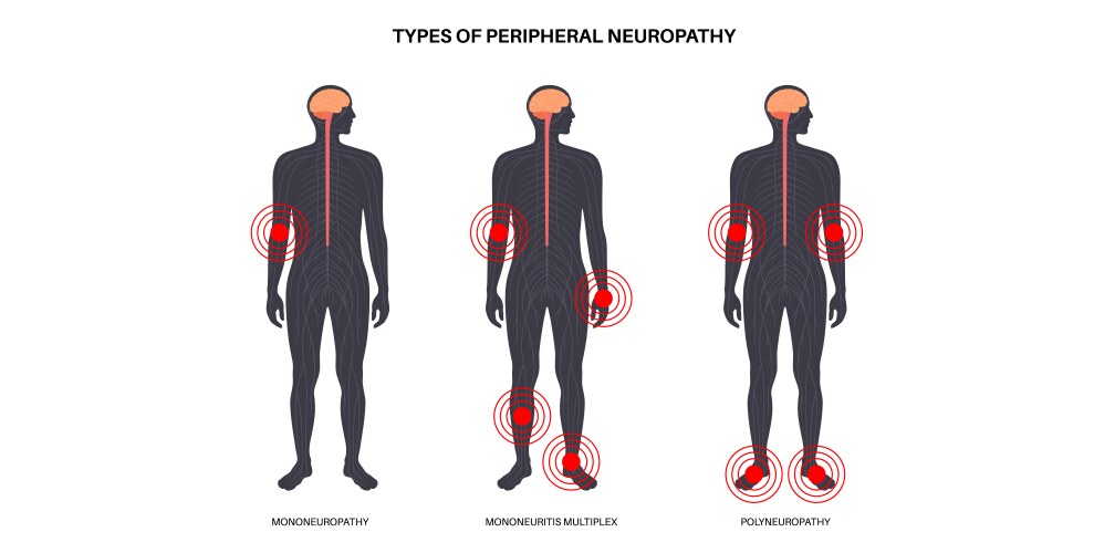 Peripheral neuropathy medical poster Royalty Free Vector