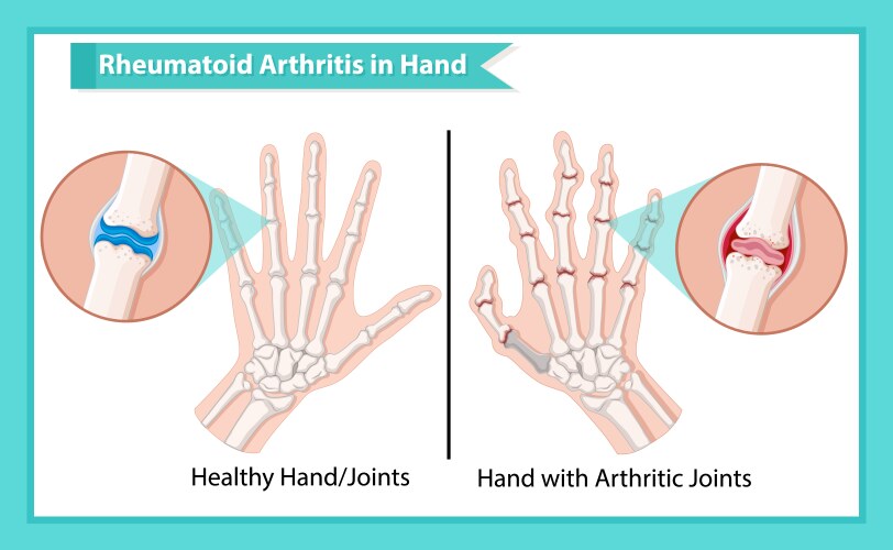Rheumatism or rheumatic disorder medical posters Vector Image