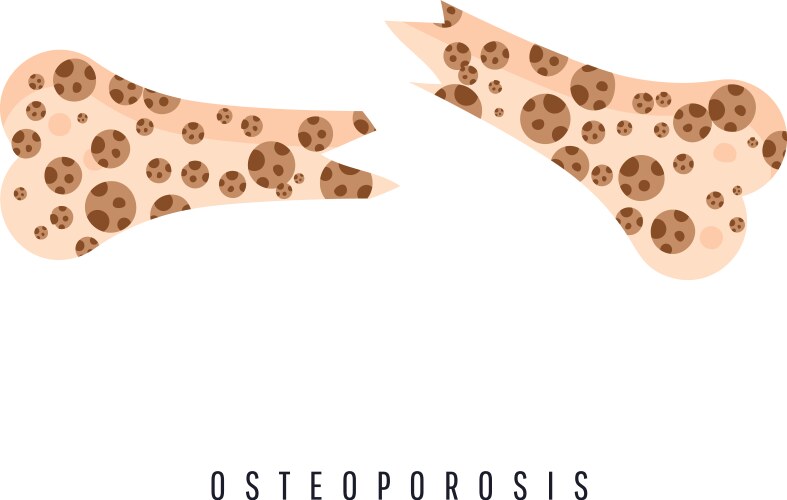 Osteoporosis stages Royalty Free Vector Image - VectorStock